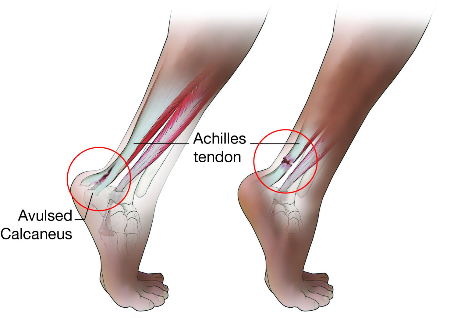 The symptoms vary with the severity of the tendon tear. Common symptoms ...